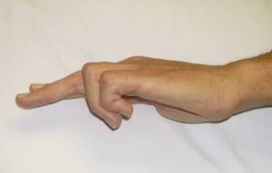 Digit Widget - to aid in the treatment of PIP flexion contractures