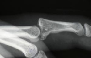 PIP Fix - Hand Biomechanics Lab