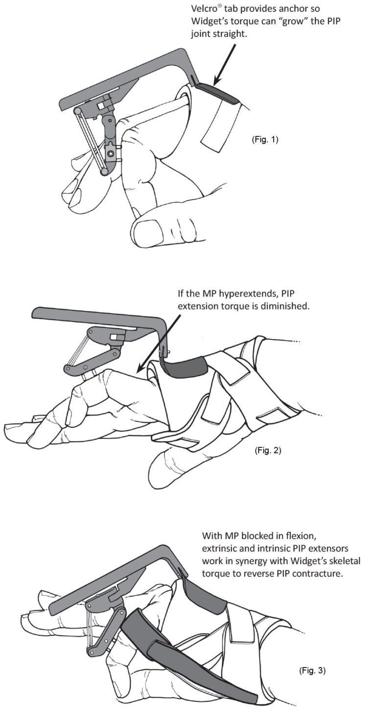 The MP and PIP Joints…how they influence each other - Hand Biomechanics Lab