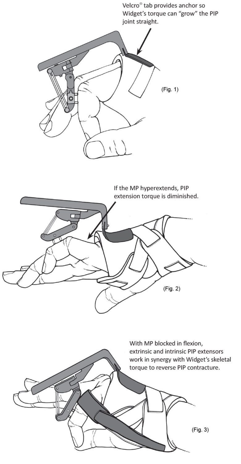 The MP and PIP Joints…how they influence each other - Hand Biomechanics Lab