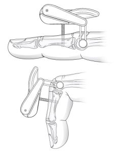 PIP Fix - Hand Biomechanics Lab